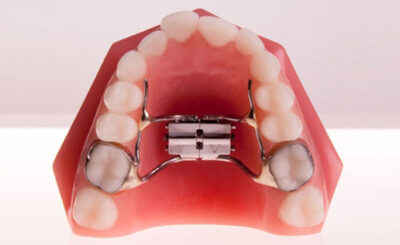 Orthodontic Palatal Expander: Benefits and Uses - Lowe Orthodontics